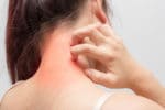 ᑕ ᑐ Milbenbisse - Milbenstiche ++ Erkennen & behandeln
